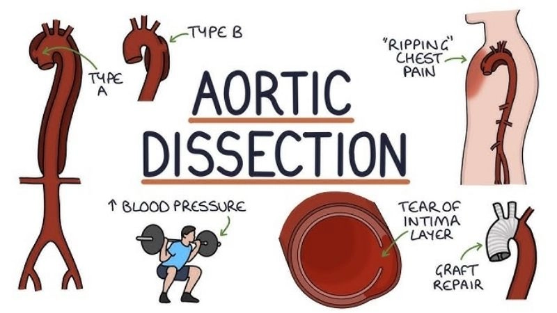 Aortic dissection causes symptoms and risk factors