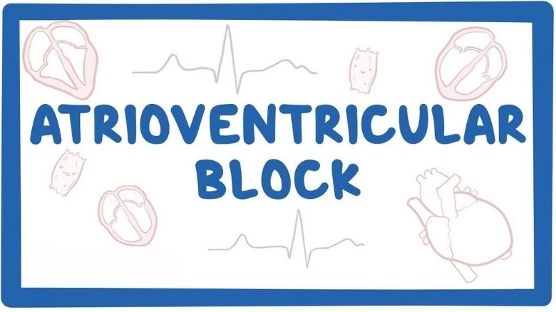 Exploring atrioventricular (AV) block symptoms and risk