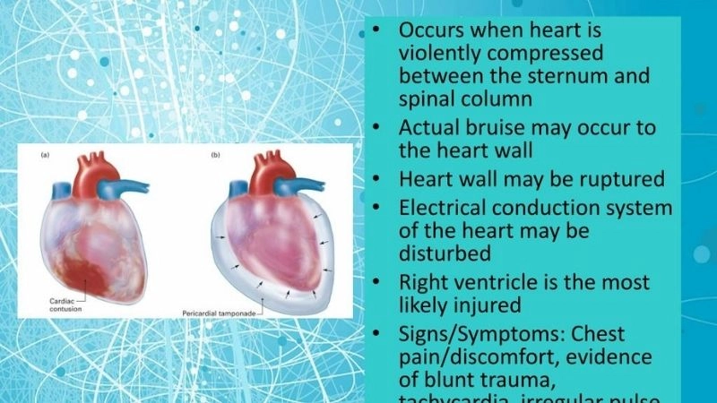 How Cardiac Contusion (Heart Trauma) affects your health
