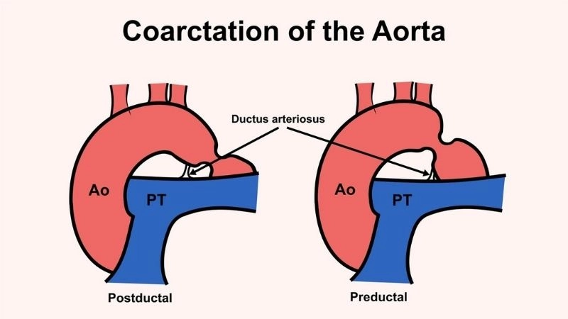 Latest insights into Coarctation of the Aorta condition