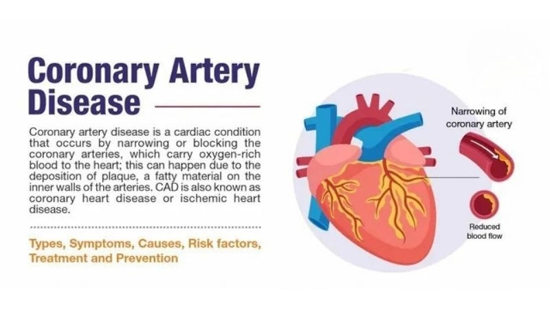 Coronary Artery Disease (CAD) overview symptoms prognosis