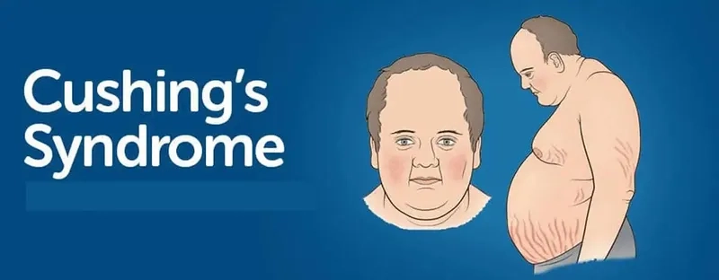 Cushing's syndrome - Recognizing the signs of high cortisol