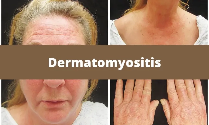 Dermatomyositis - What you need to know about this condition?