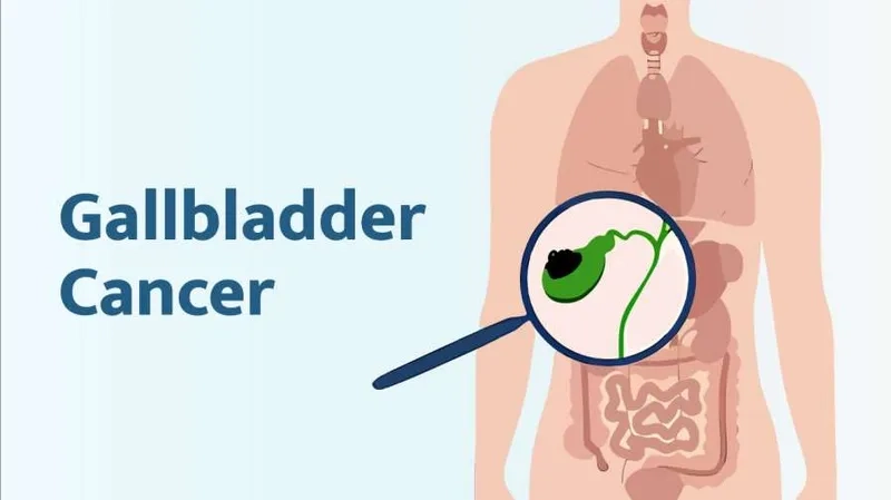 Gallbladder Cancer - Stages of disease development