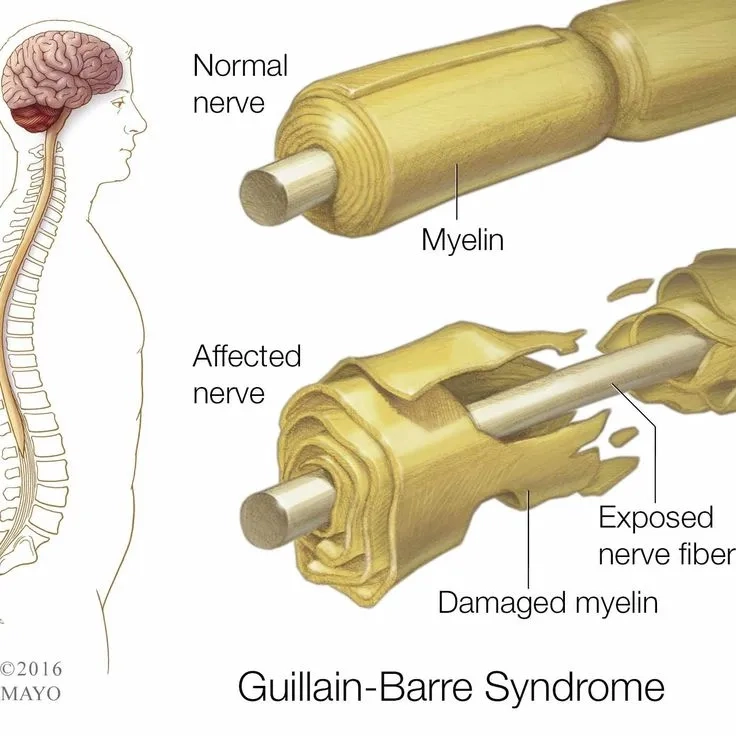 The challenging road to recovery from Guillain-Barré syndrome