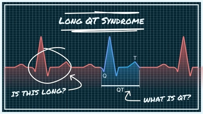 Long QT Syndrome (LQTS) overview for better health