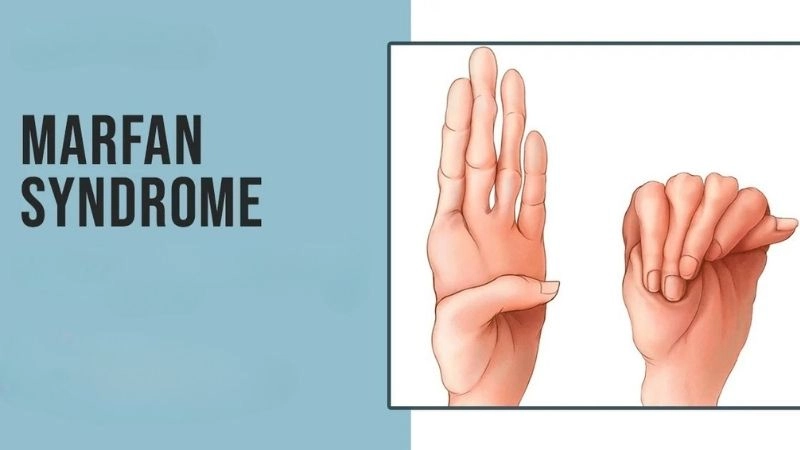 Key facts about marfan syndrome symptoms and complications