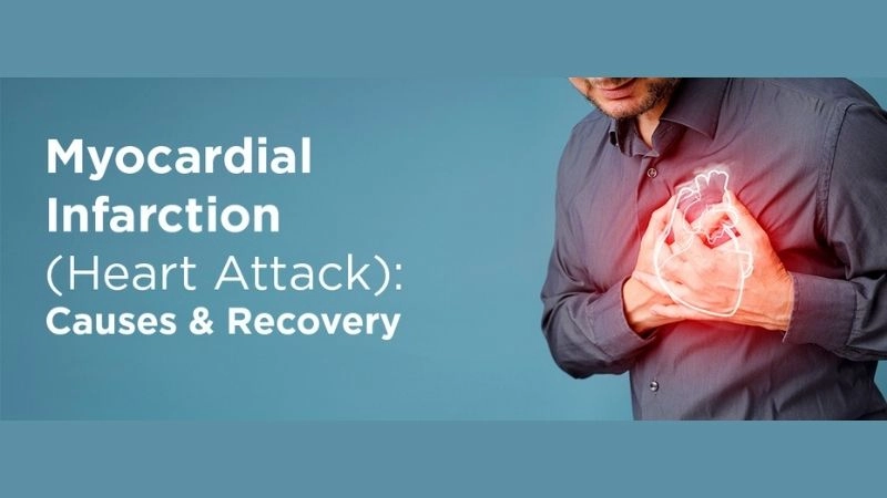 Myocardial Infarction (Heart Attack) health overview