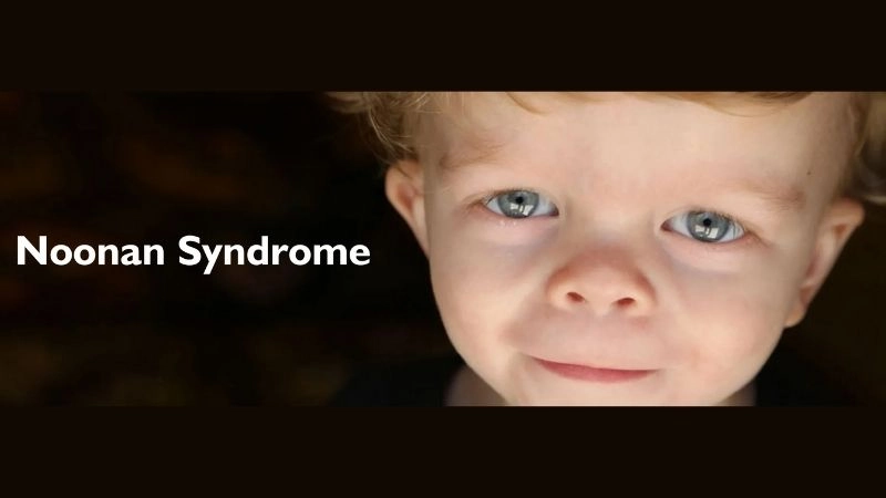 Understanding symptoms and causes of Noonan Syndrome