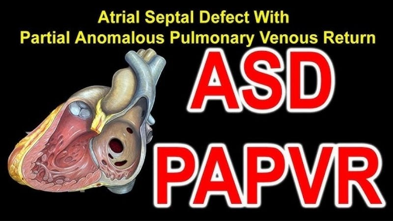 Partial Anomalous Pulmonary Venous Return (PAPVR) overview