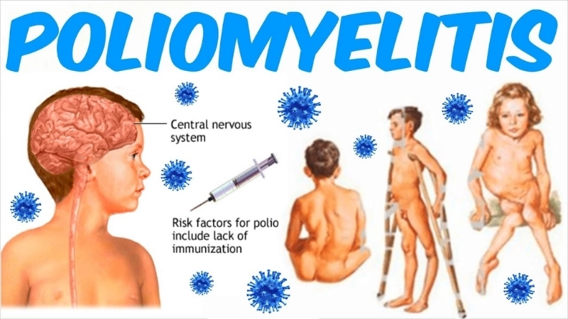 Understanding poliomyelitis (Polio) and its prevention