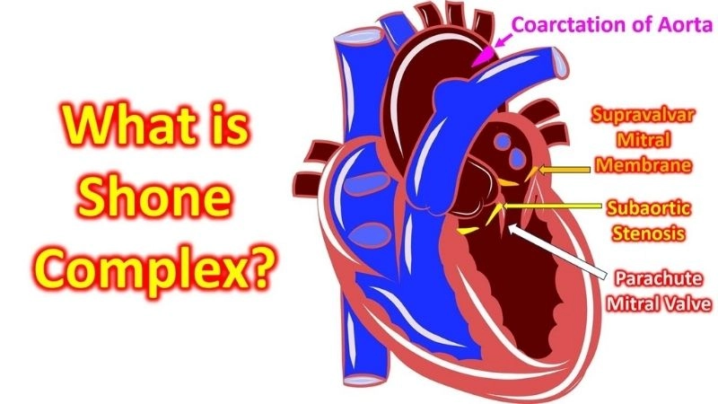 Exploring Shone S Complex Causes Risks And Outcomes