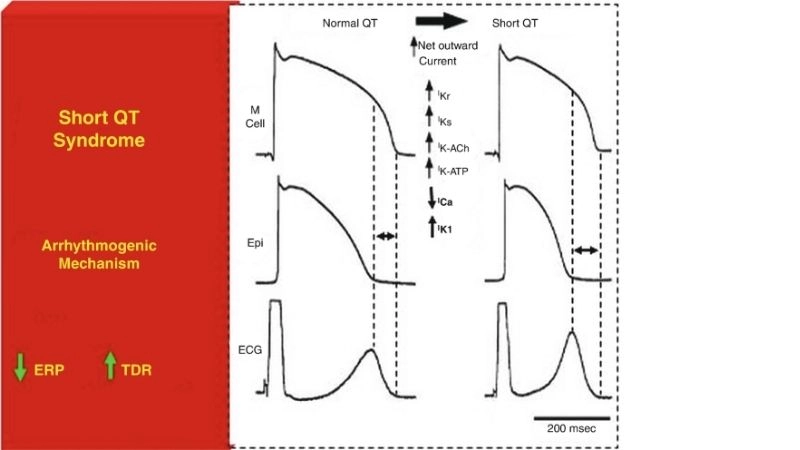 Understanding Short QT Syndrome (SQTS) and its impact