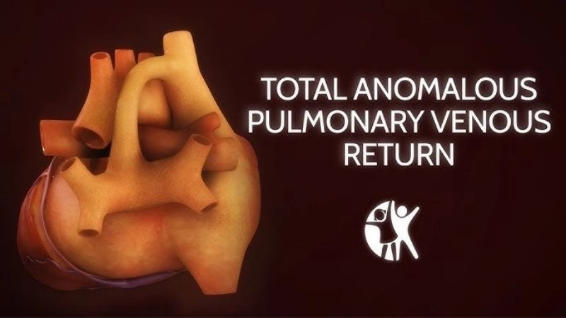 Total Anomalous Pulmonary Venous Return (TAPVR) overview