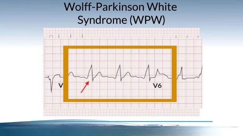 Wolff Parkinson White (WPW) Syndrome causes explained