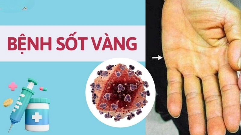 Understanding Yellow Fever symptoms and prevention tips
